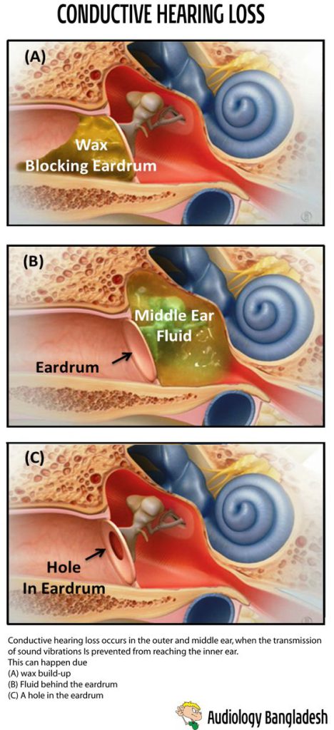 What Causes a Bad Ear Infection? - 4Nids